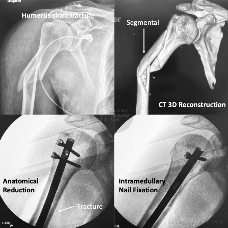 Shoulder Fracture - Proximal Humerus | Medical Case Study